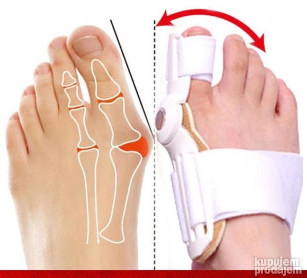 Ortopedski korektor čukljeva - KupujemProdajem